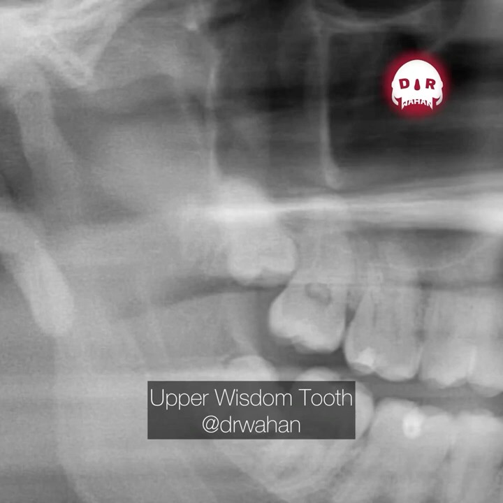 Upper Wisdom Tooth Awesomeness - YouTube