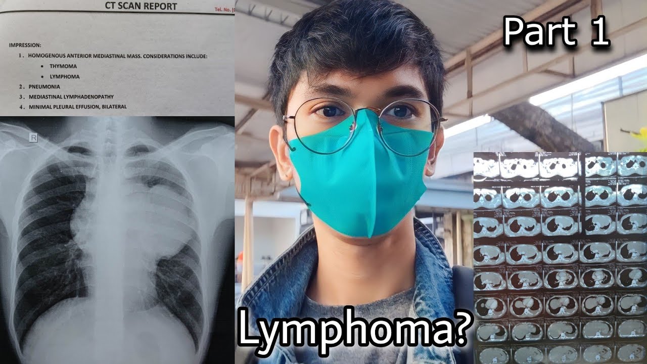 Part 1: Anterior Mediastinal Mass (consider Lymphoma) Pneumonia and ...