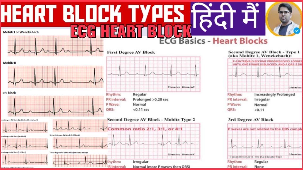ECG REPORT TYPES OF HEART BLOCK ECG AV BLOCK ECG HEART ECG REPORT TYPES OF HEART BLOCK ECG AV BLOCK ECG HEART