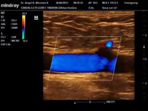 VENA FEMORAL Y CAYADO DE SAFENA MAGNA - YouTube