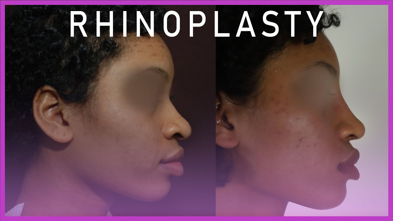 Nose Job (Ethnic Rhinoplasty) Surgery in L.A - YouTube