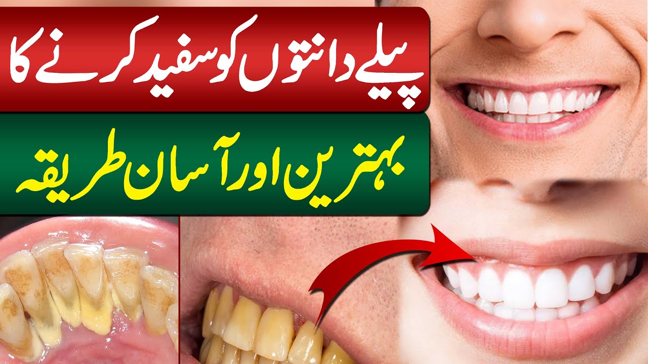 How To Whiten Your Yellow Teeth - Yellow Teeth Cleaning at Home - Teeth ...