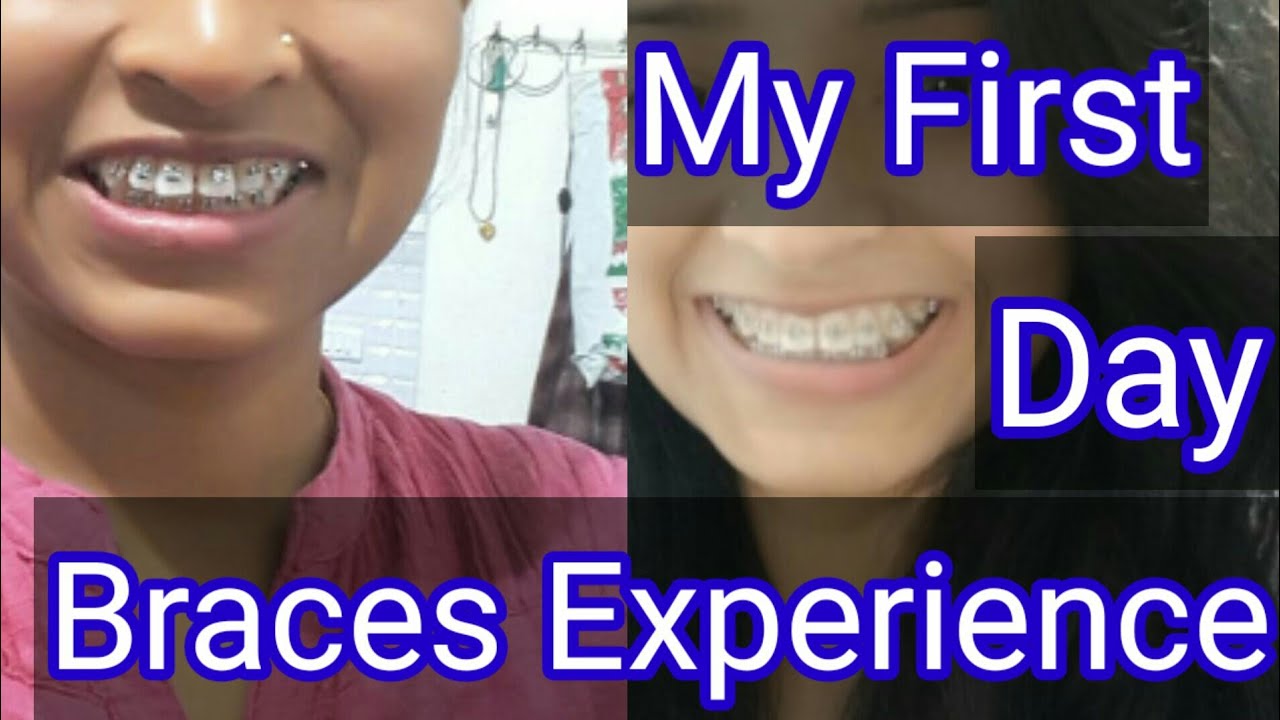 First Day Braces journey experience ,Metal Braces, पहला दिन दातो के तार ...