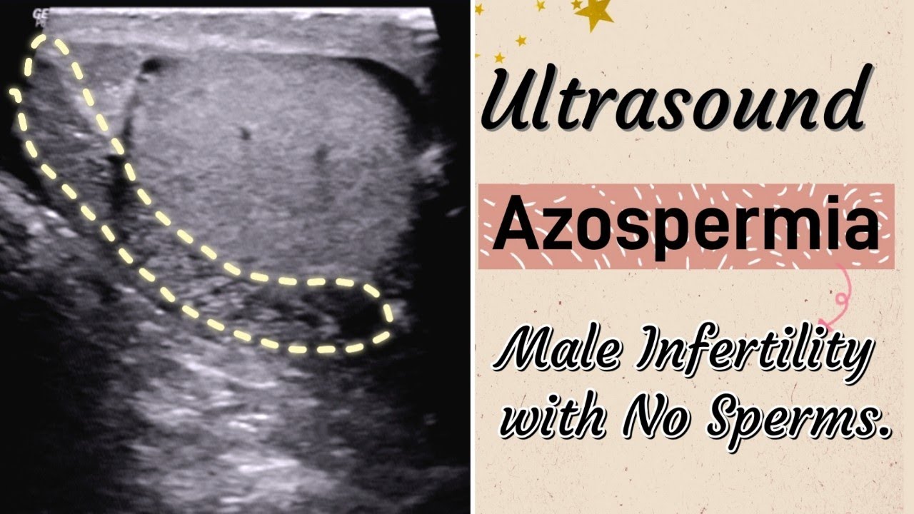 Scrotal Ultrasound - Azoospermia | Type,Causes -Male Infertility with ...