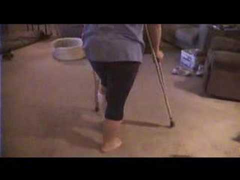 My wife in her plaster short leg cast - YouTube