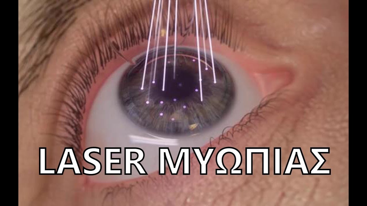 LASER μυωπίας - ΟΦΘΑΛΜΙΑΤΡΟΣ - YouTube