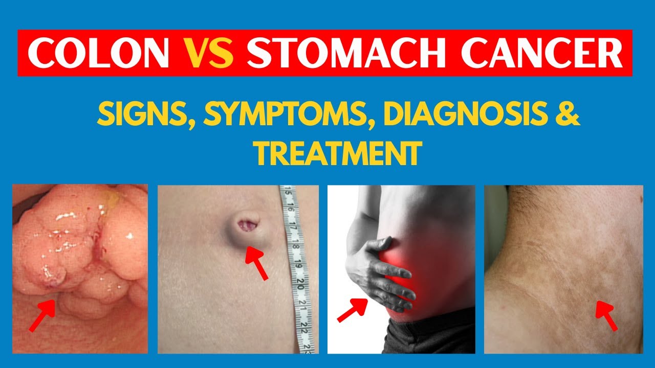 Stomach Cancer vs Colon Cancer | Signs & Symptoms Most People Ignore ...