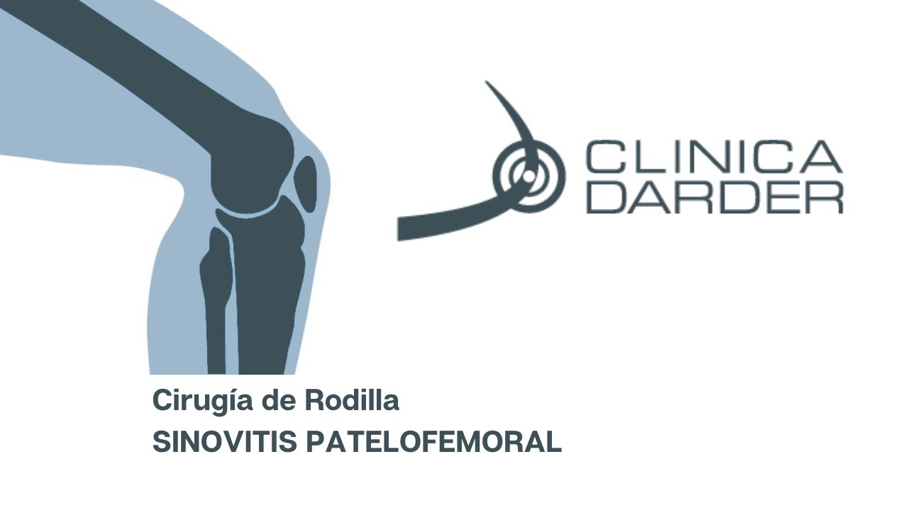 Sinovitis Patelofemoral - Tratamientos Rodilla Clínica Darder ...