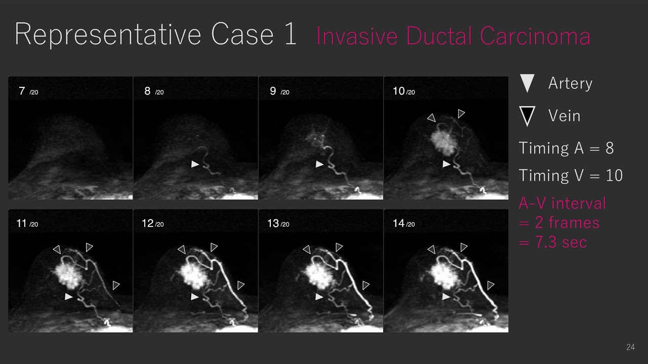 Natsuko Onishi - Ultrafast DCE MRI of the Breast Using CS - YouTube