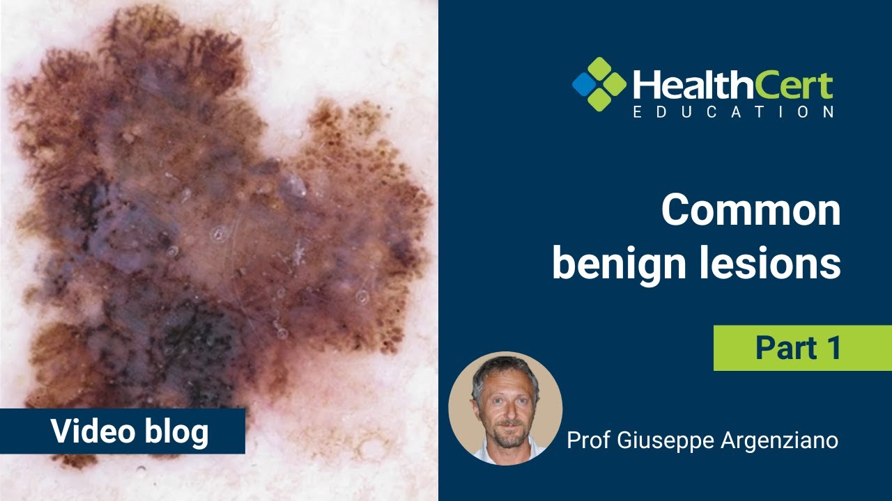Common benign lesions Part 1 | Prof Giuseppe Argenziano - YouTube