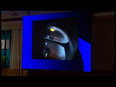 LASER in Angle Closure Glaucoma and Bleb remodelling