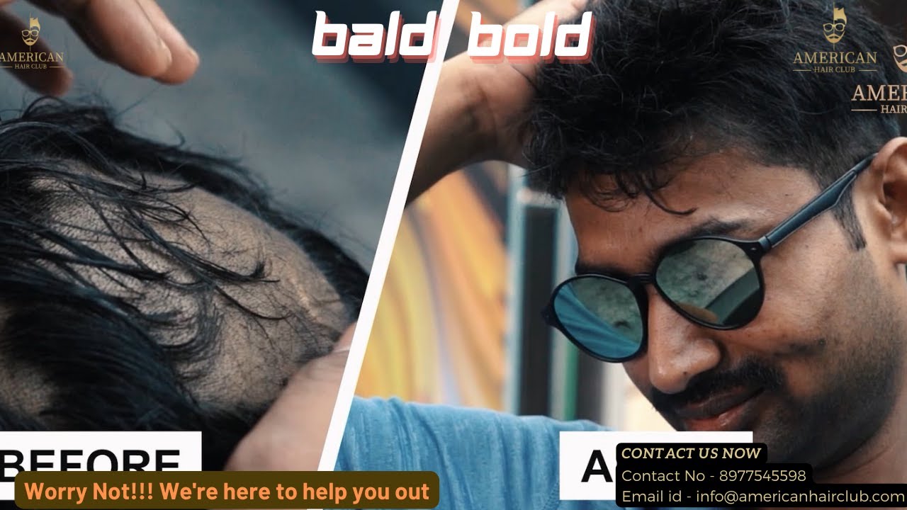 American Hair Club - Best Hair Replacement Service in Hyderabad | Best ...