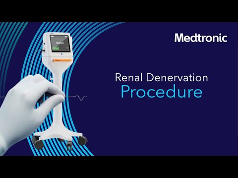Radiofrequency Renal Denervation Procedure - YouTube