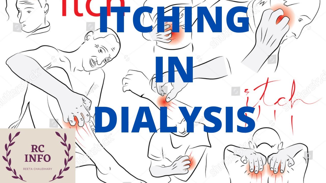 Itching in dialysis/Complications of hemodialysis/Itching during ...