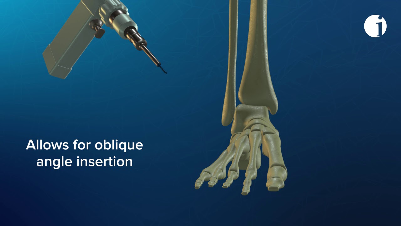 Integrant 2mm Screw - YouTube