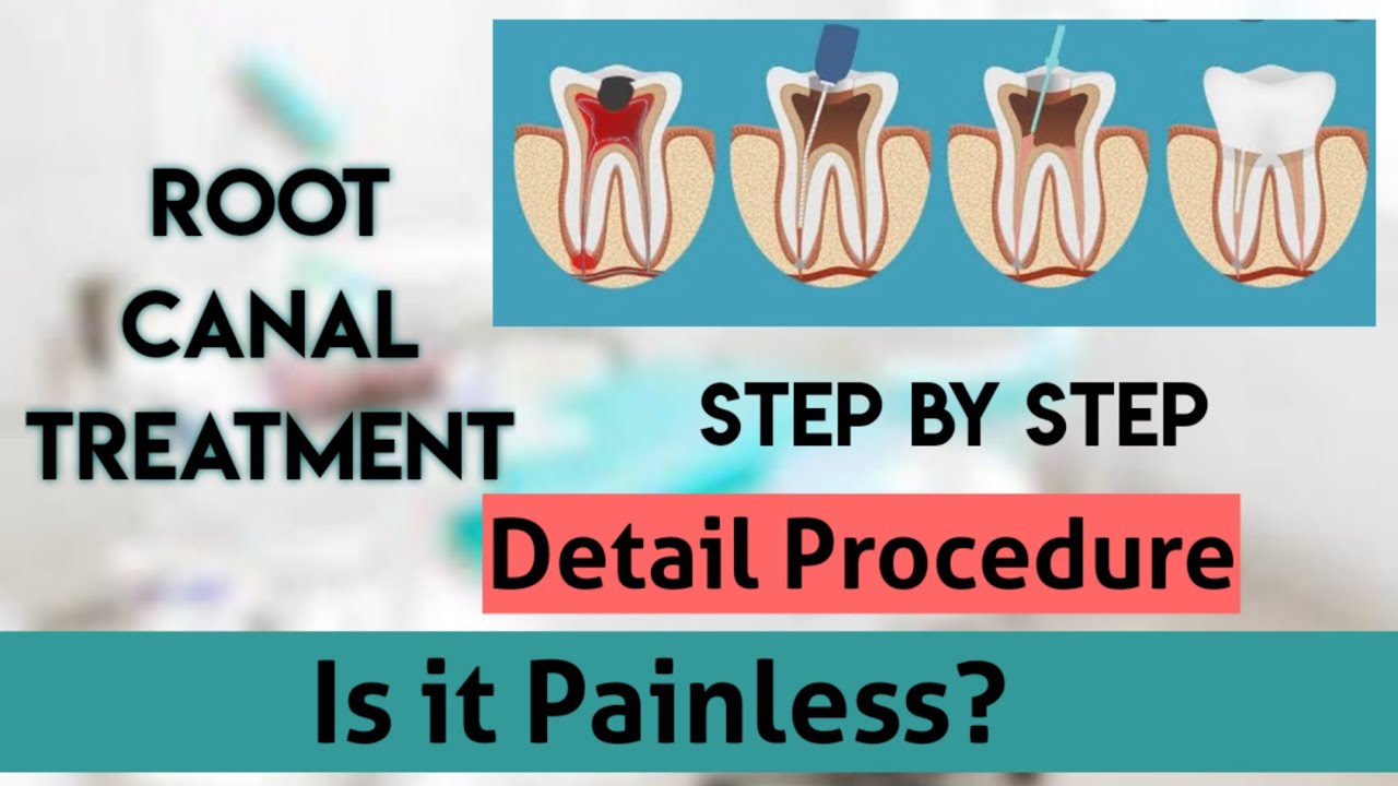 Root Canal Treatment l नसों का इलाज l What is RCT? Step by Step ...