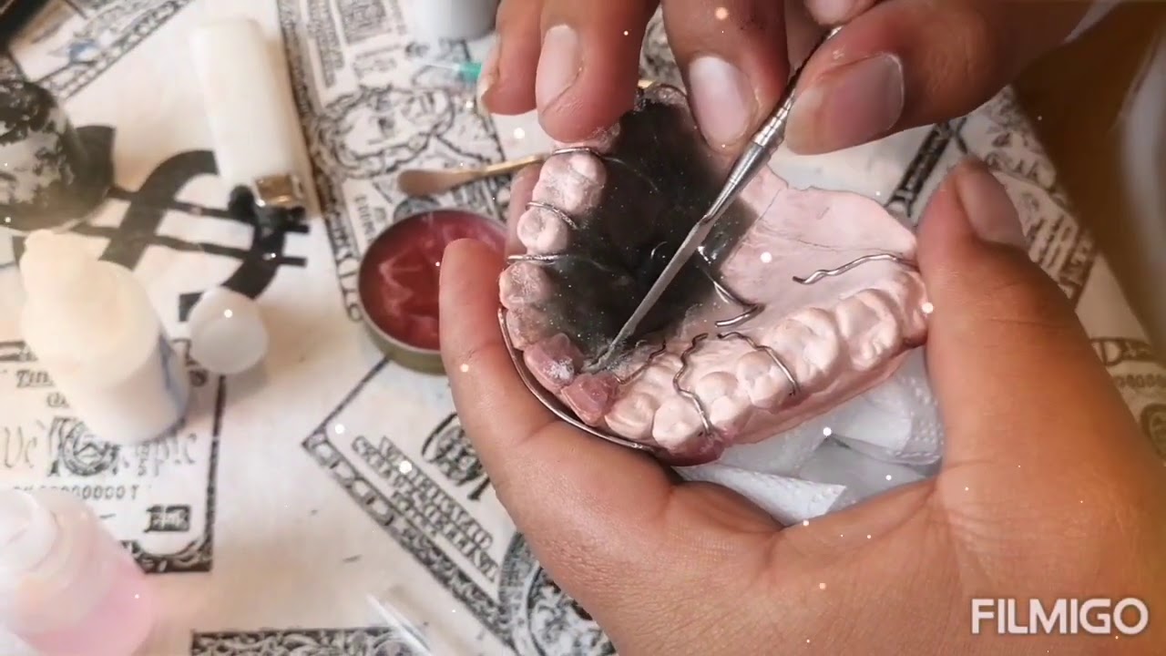 Placa de ortodoncia... Arco de hawley, circunferencial medio y entero ...