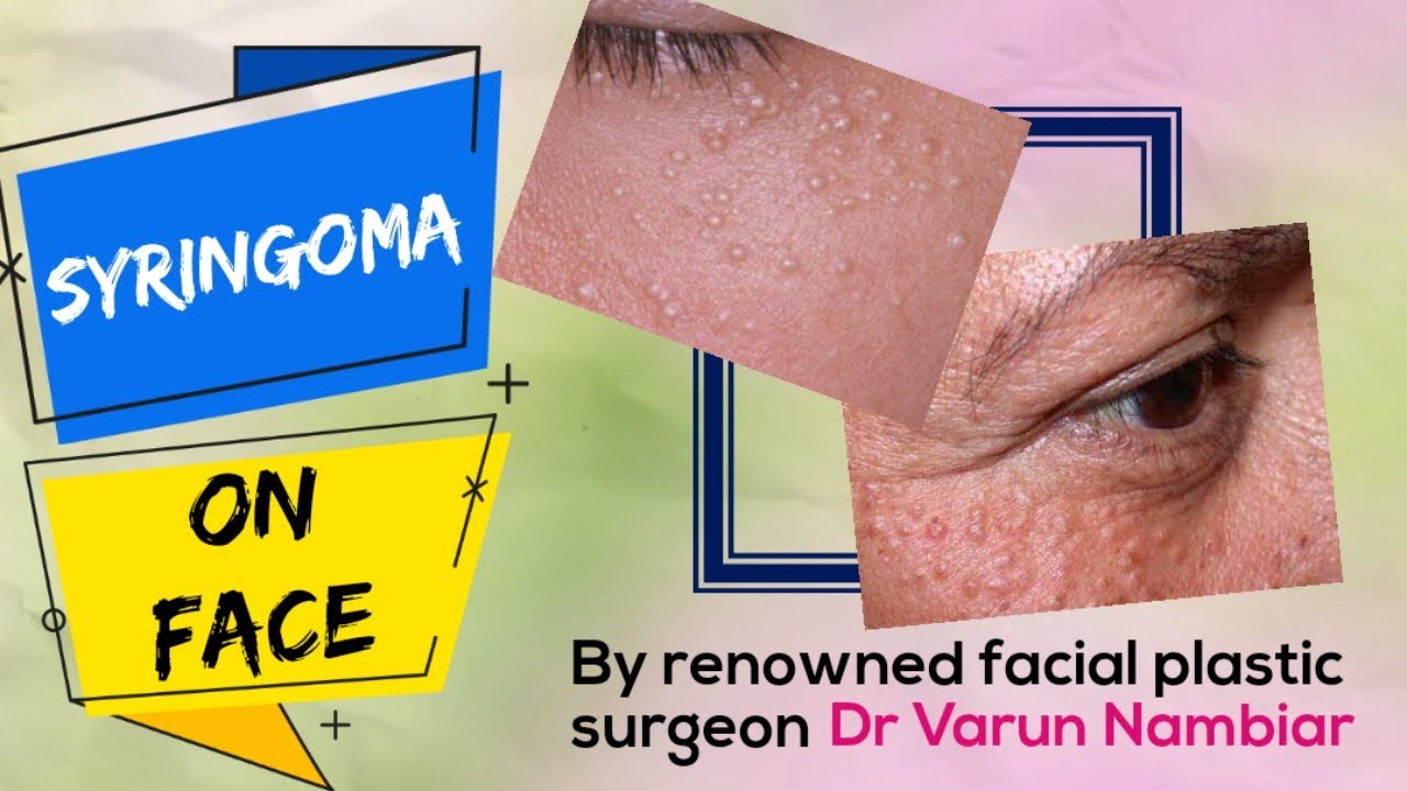 Treatment of syringoma by Facial plastic surgeon in Kerala - YouTube