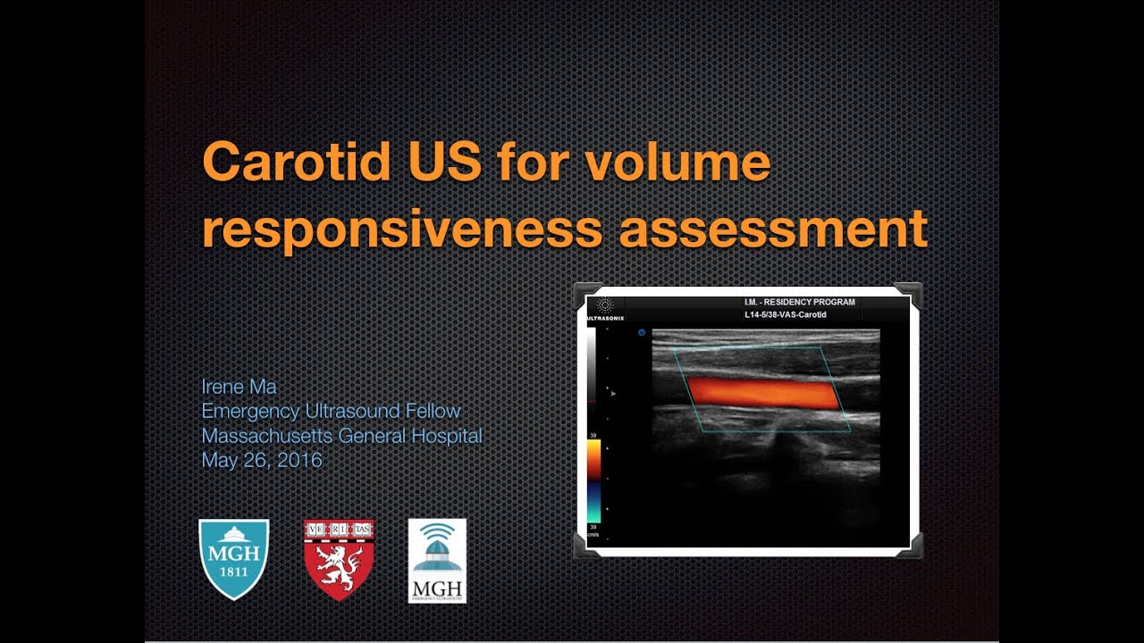 Carotid ultrasound for volume responsiveness assessment - YouTube