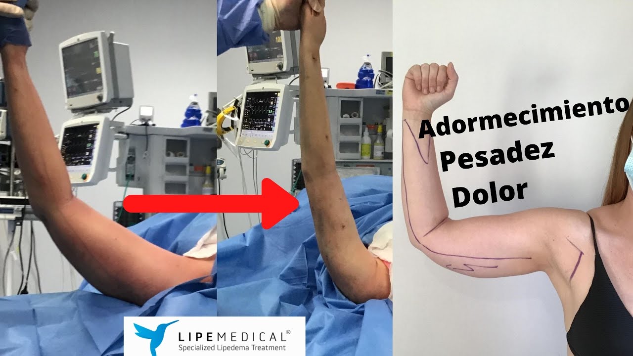EXTRACCIÓN de LIPEDEMA EN BRAZOS: quitaron 3,6 litros de grasa ...