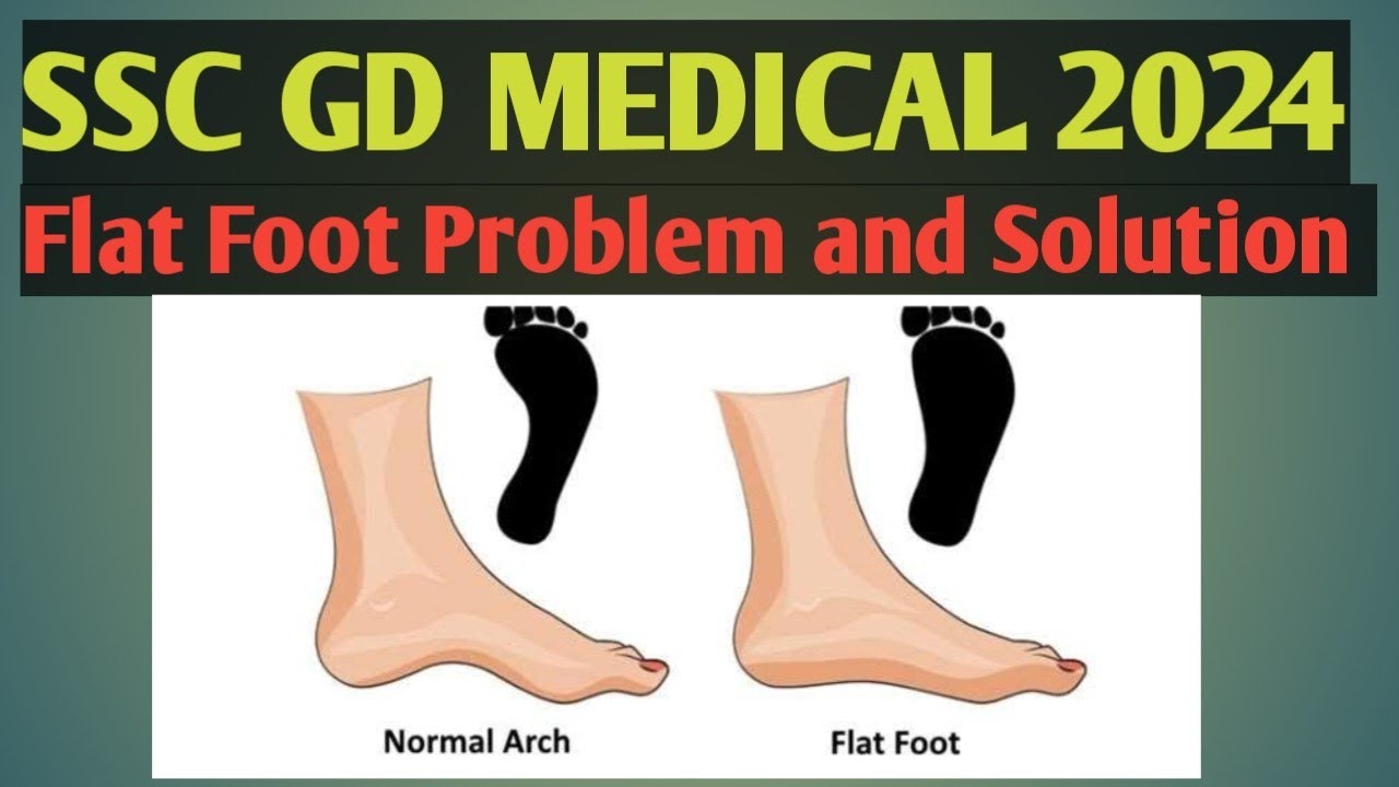 FLAT FOOT Problem And Solution SSC GD MEDICAL #ssc #sscgd #flatfoot # ...
