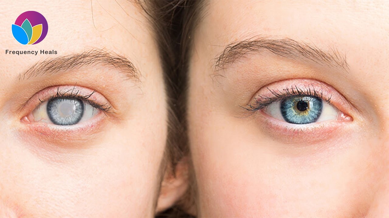 Cataract Management | Improve Your Vision & Stop Further Clouding of ...