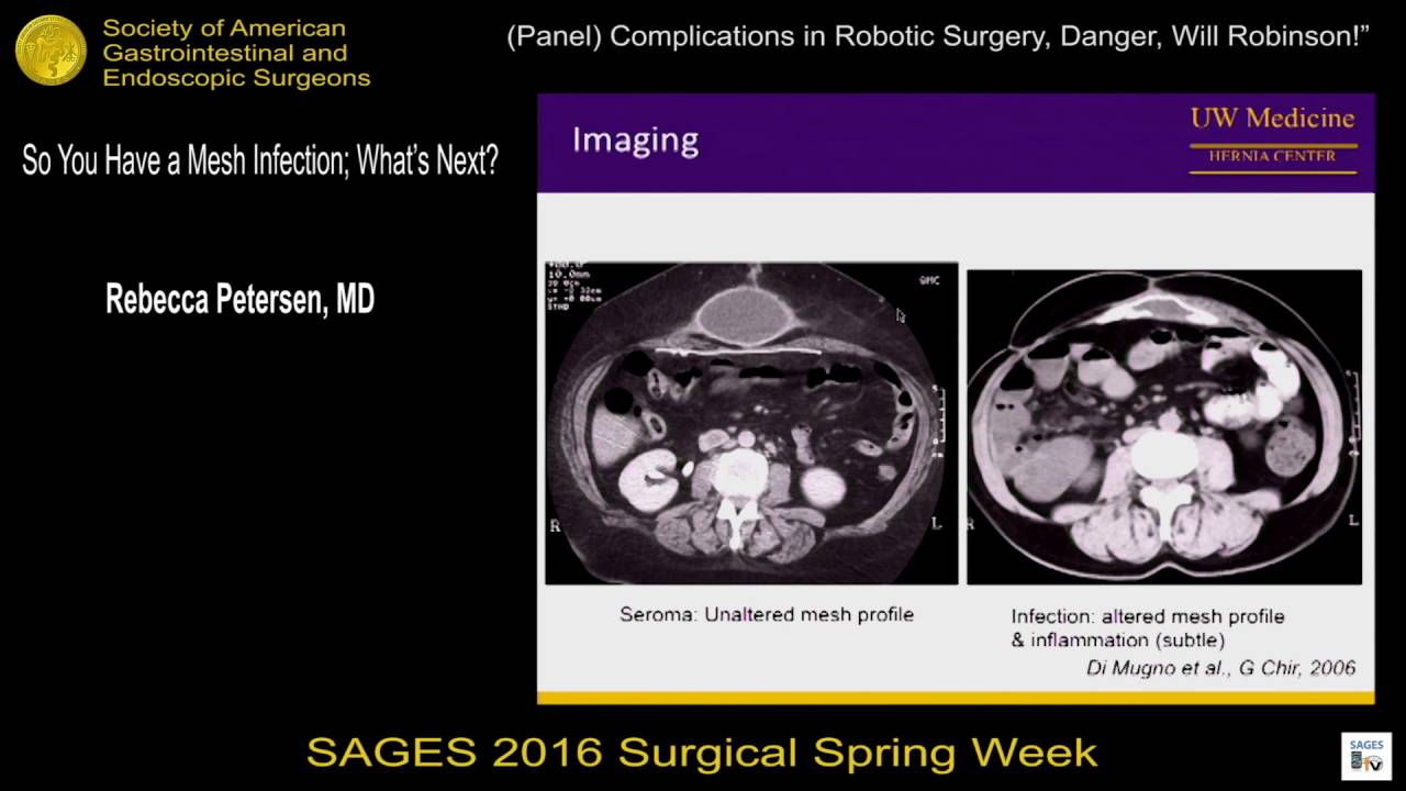So you have a mesh infection; What's next? - YouTube