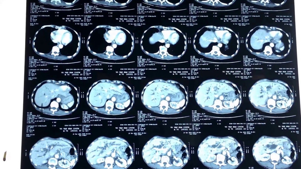 Phân tích hình ảnh CT scan một trường hợp tắc mật - YouTube