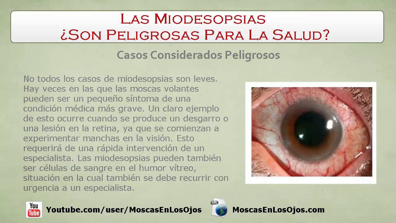 Las Miodesopsias Son Peligrosas?: Son Realmente Peligrosas Para La ...