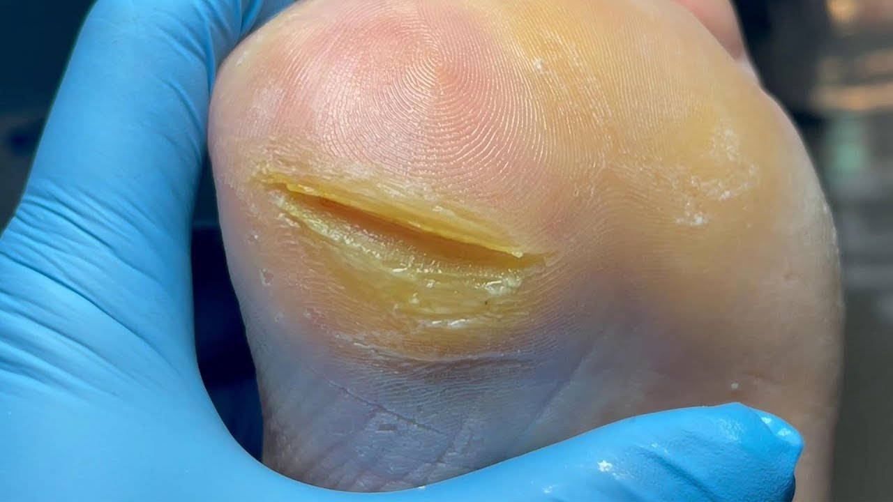 Super Large Cracks On The Soles Of The Feet, Scraped Hard Skin【Pedicure ...