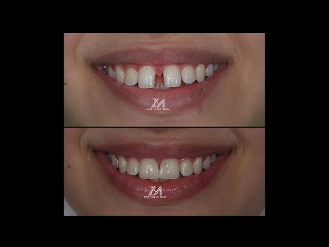 diastema closure using bioclear method - YouTube