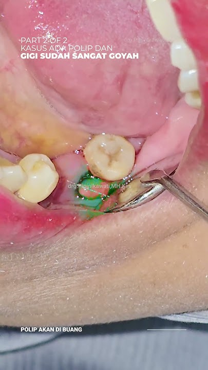 KASUS ADA POLIP DAN GIGI SUDAH SANGAT GOYAH || PART 2 OF 2 - YouTube
