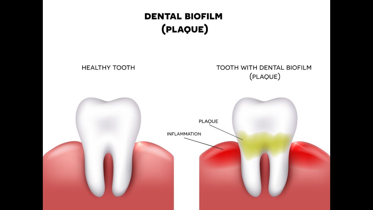 Periodontology - Phases of Plaque Formation - YouTube