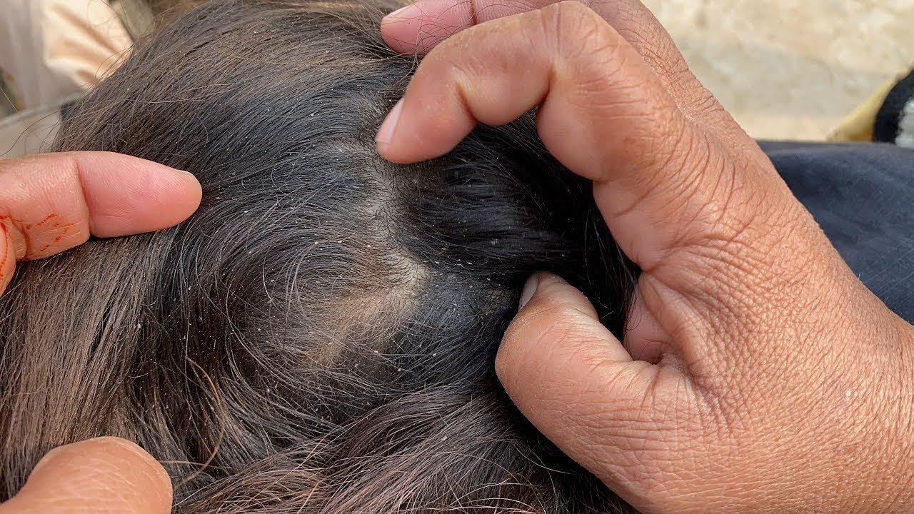 #ASMR checking lice and nits. and hunting lots ofnits 💯 asmr lice check ...