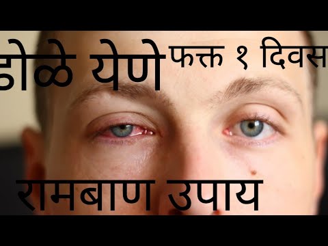 डोळे येणे वर रामबाण उपाय | Conjunctivitis| Dole yene gharguti upay ...