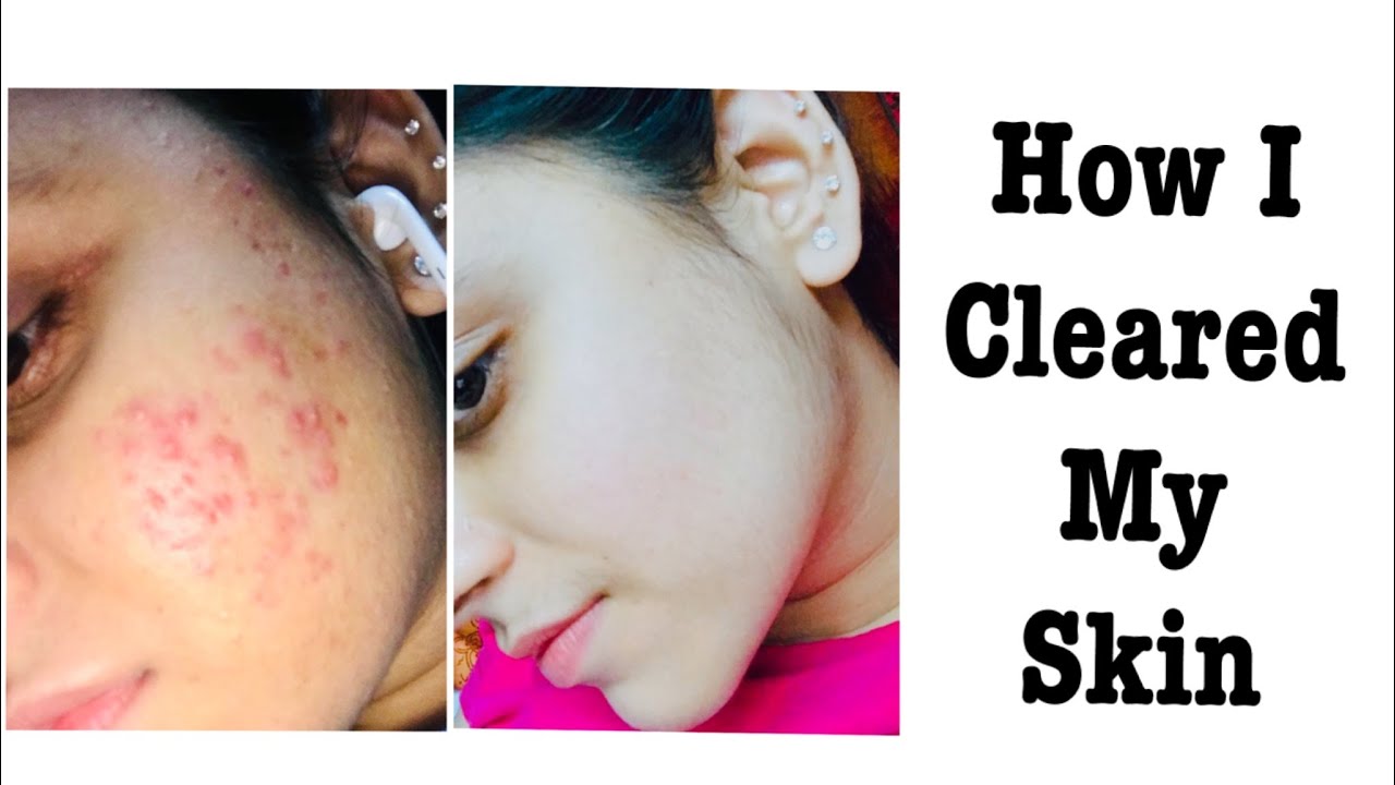 How I cleared my acne | Clear skin tips | my acne story - YouTube