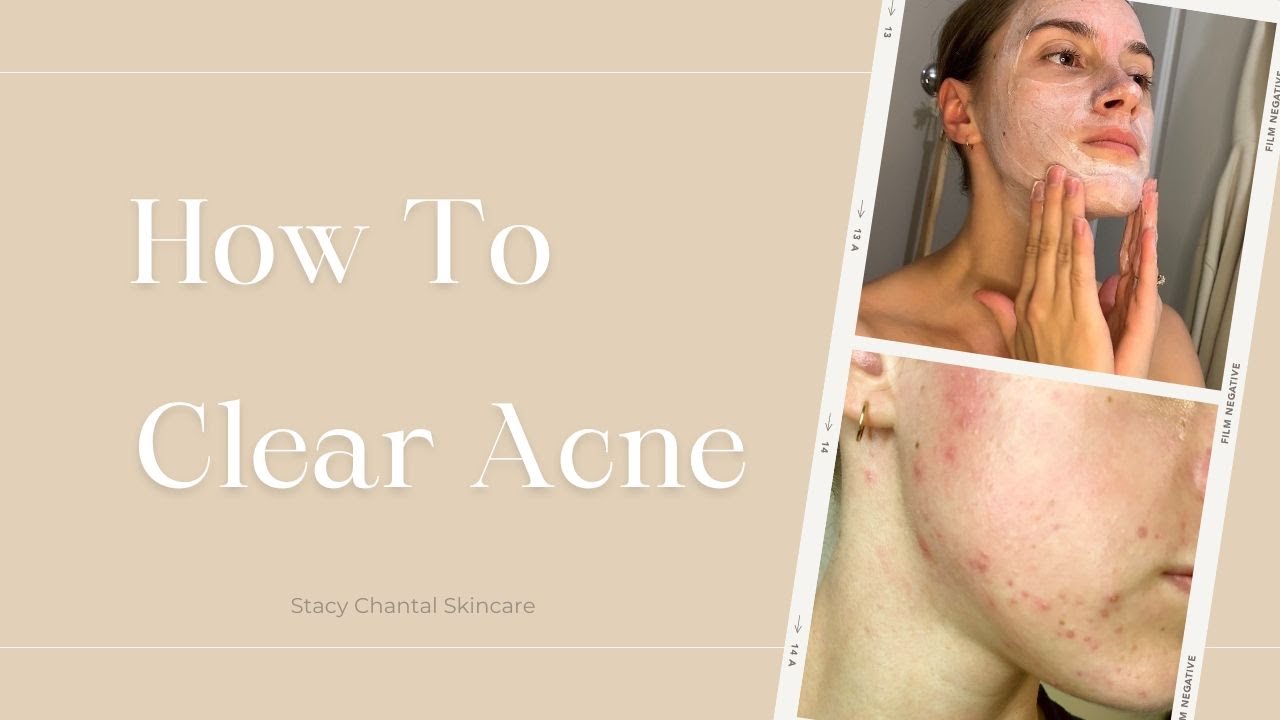 HOW TO CLEAR ACNE - YouTube