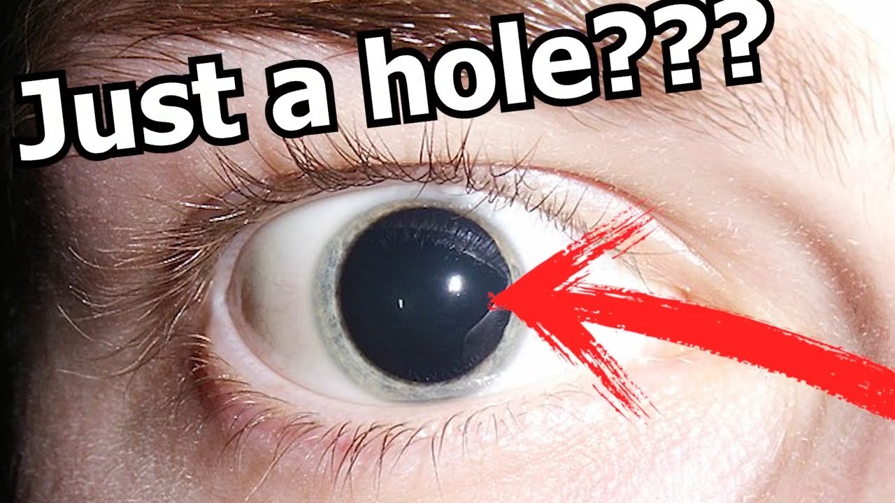 What is the pupil? USMLE Step 1 Review: Miosis vs Mydriasis - YouTube