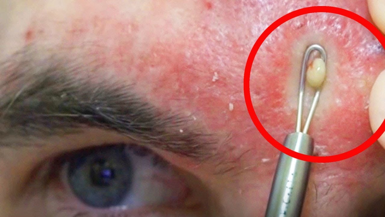 Cystic Acne Vs Dreaded T Zone Pimples On Forehead YouTube cystic-acne-vs-dreaded-t-zone-pimples-on-forehead-youtube