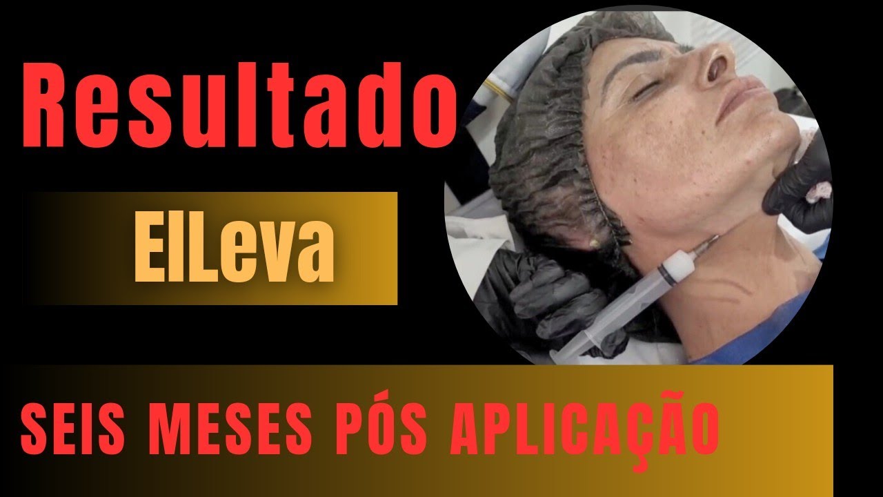 Como fica o Resultado Do Elleva Bioestimulador! Após 6 meses@RennovaOficial - YouTube