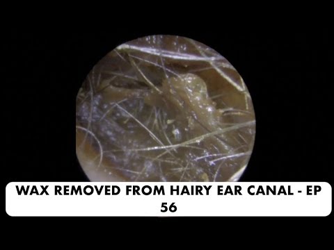 DIFFICULT EAR WAX REMOVAL FROM HAIRY EAR CANAL - EP 56 - YouTube