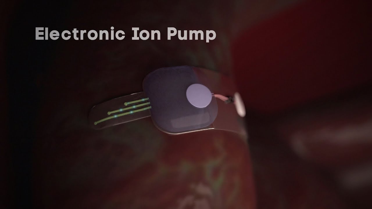 Future therapy with the electronic ion pump - YouTube