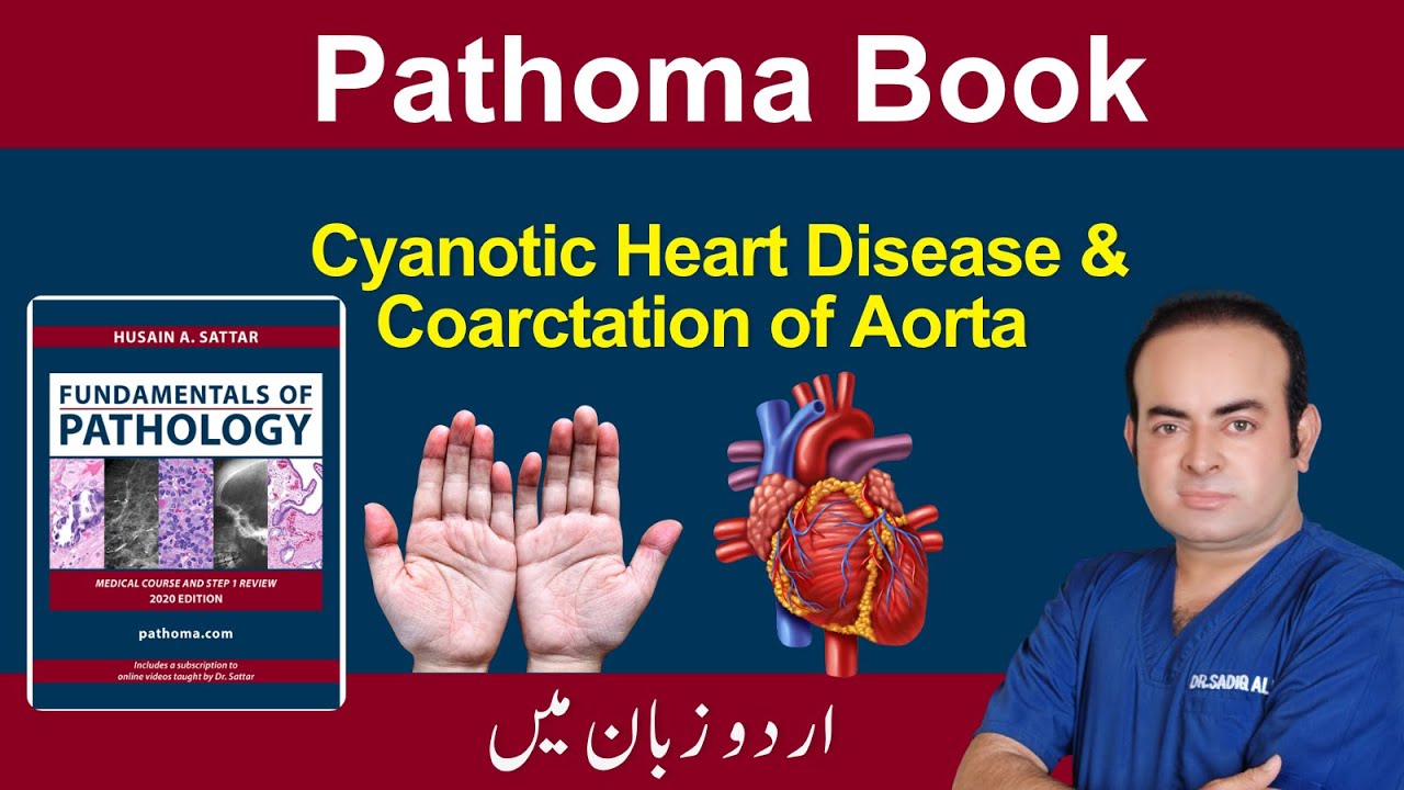 Cyanotic Heart Diseases & Coarctation of Aorta | Pathoma Simplified for ...