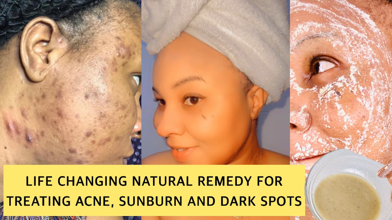 SECRET NATURAL INGREDIENTS FOR TREATING (ACNE,SUNBURN,DARK SPOTS ...