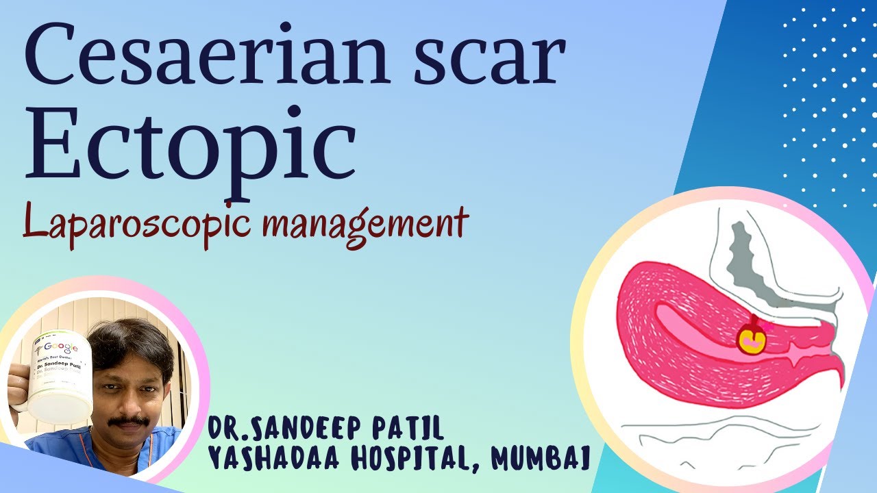 Cesarean Scar Ectopic : Laparoscopic Surgery - YouTube