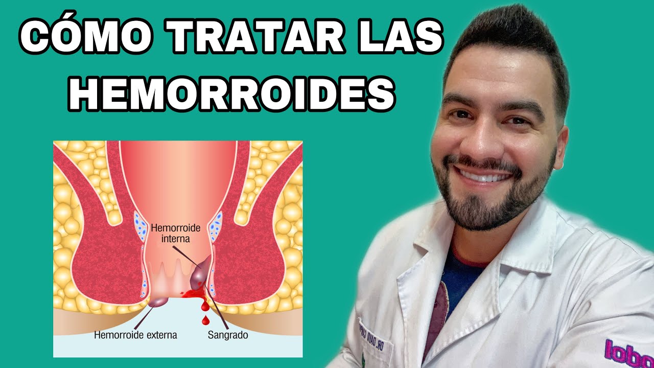 QUE SON LAS HEMORROIDES Y COMO TRATARLAS / HEMORROIDES | DR. DAVID ...
