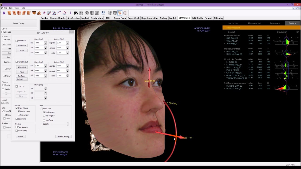 FAce 3D CT 정밀진단시스템 - YouTube