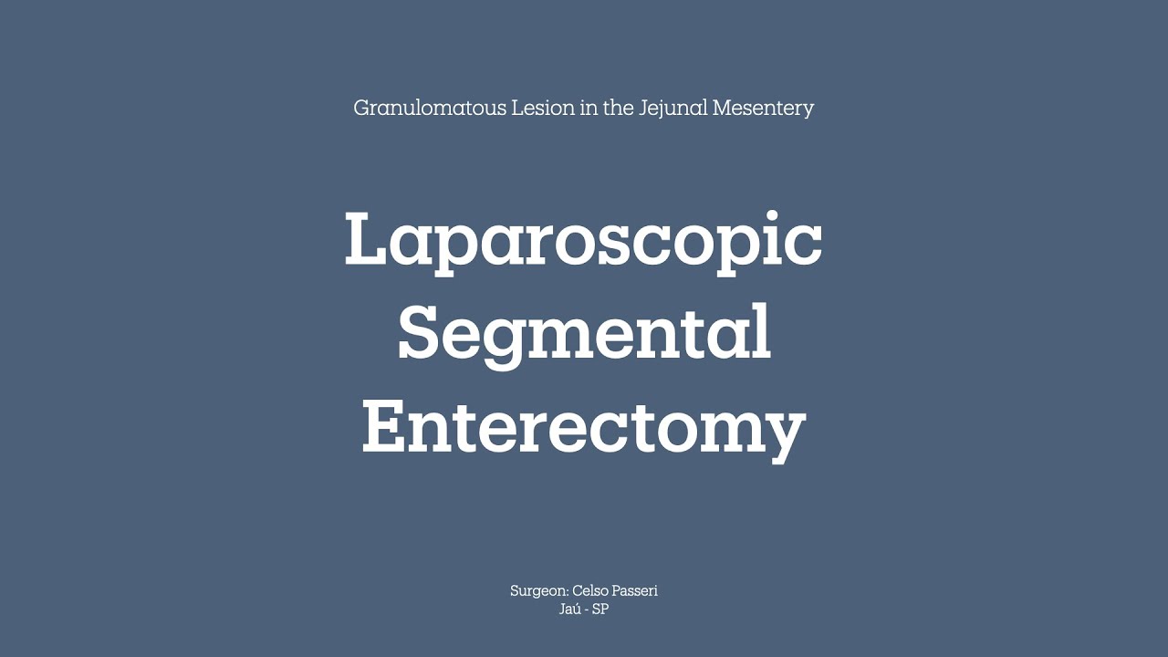 Segmental enterectomy - YouTube
