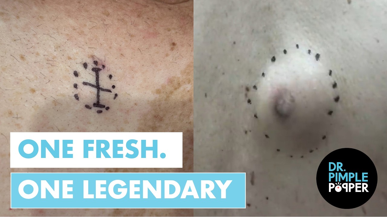 One Fresh Back Cyst and One YouTube Legend | Dr. Pimple Popper - YouTube