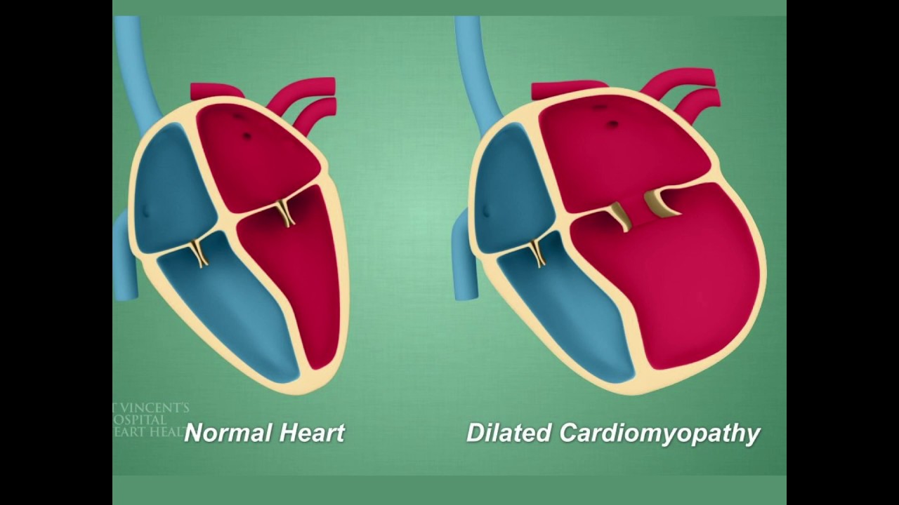 Dilated Cardiomyopathy Part 1: Introduction and Etiology - YouTube